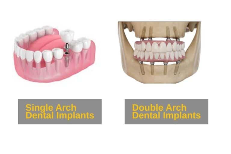 Single Arch vs. Double Arch Dental Implants